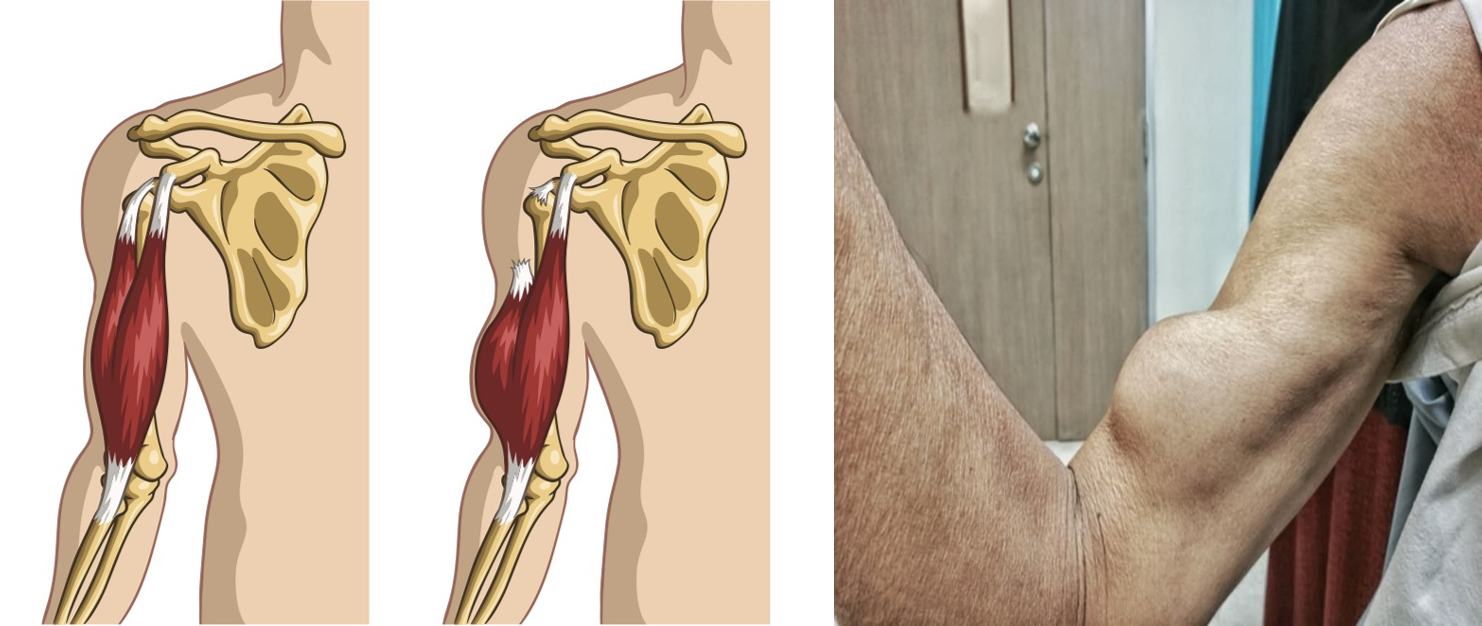 Tendinite bicipital - Avantefisio