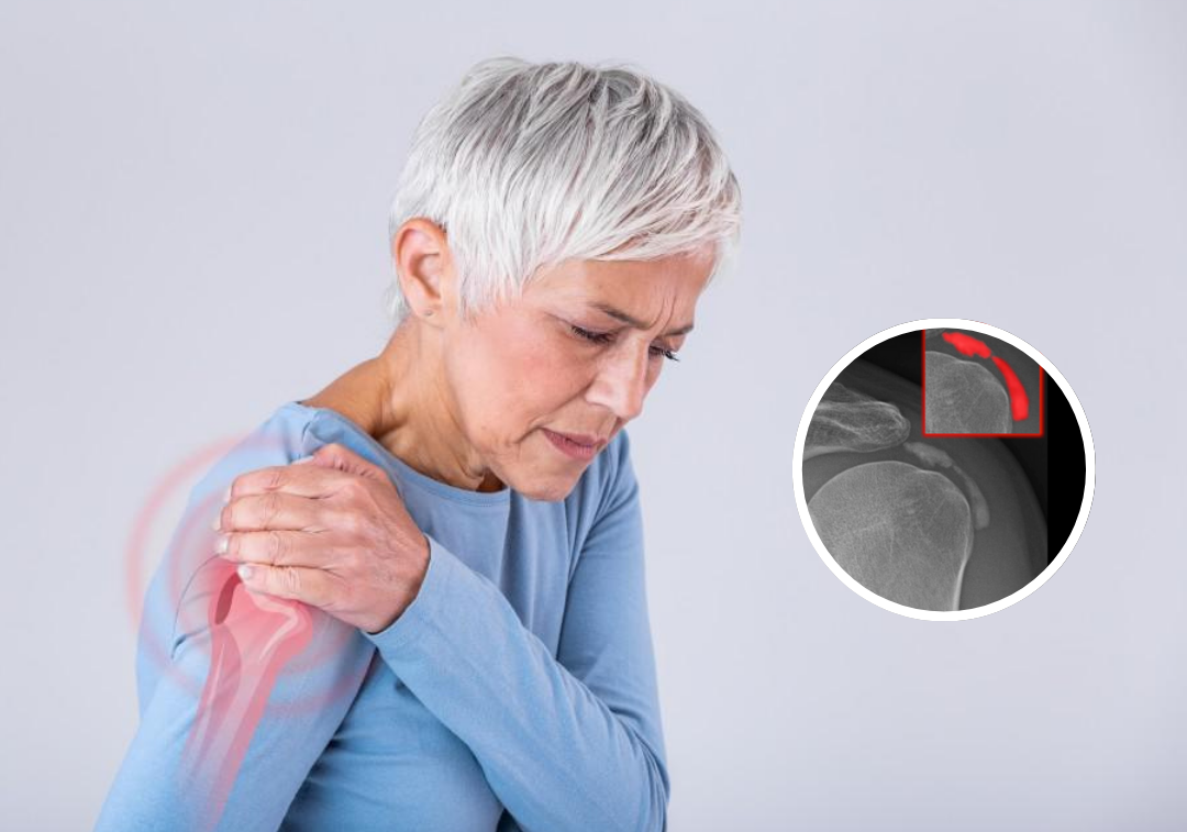 Bursite no ombro: causas, sintomas e tratamento - Avantefisio