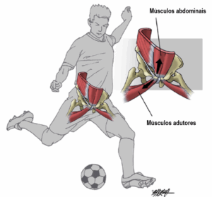 Pubalgia: Causas, Sintomas, Diagnóstico e Tratamento - Avantefisio